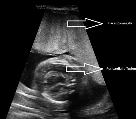 Fetal Pericardial Effusion And Placentomegaly Download Scientific Diagram