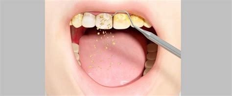 Tak Perlu Scaling Ini Cara Cegah Munculnya Noda Kuning Di Permukaan