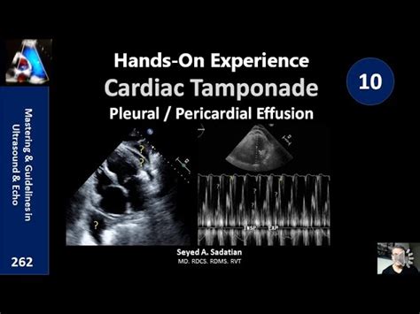 Pericardial Effusion Echo