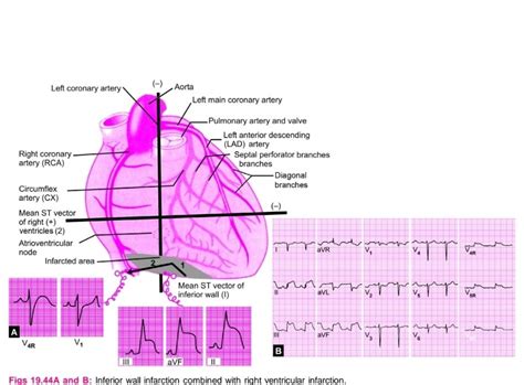 The Heart 🔴right Ventricular Rv Infarction A