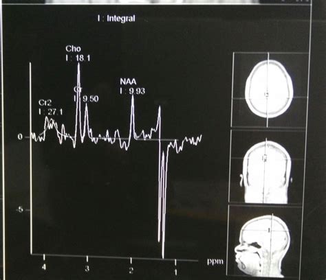 A Rare Case Of Tumefactive Demyelination Eurorad