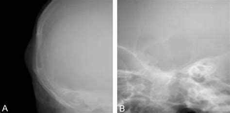 Frontal A And Lateral B Conventional Radiographs Of The Skull Download Scientific Diagram
