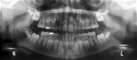 Primary And Permanent Dentition Eruption Sequences Anomalies Of Tooth Structure Dentalcare