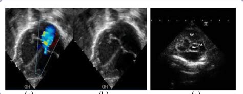 A Fetal Echocardiography Colored Doppler Showing No Patency Of The