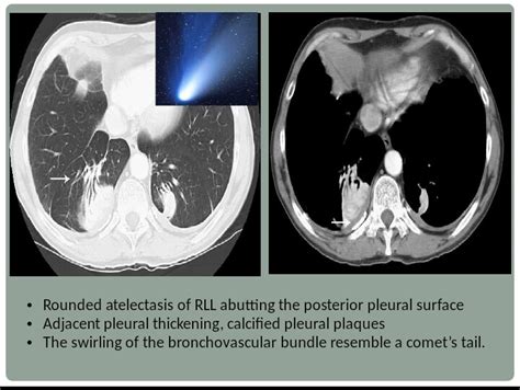 Chest Medicine Made Easy Dr Deepu Comet Tail Sign