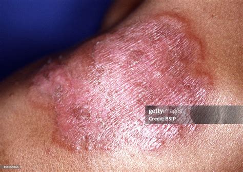 Sweets Syndrome Also Known As Acute Febrile Neutrophilic News