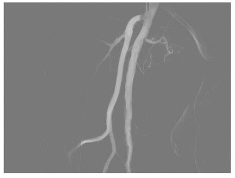 Digital Subtraction Angiography Dsa Technical And Diagnostic Aspects