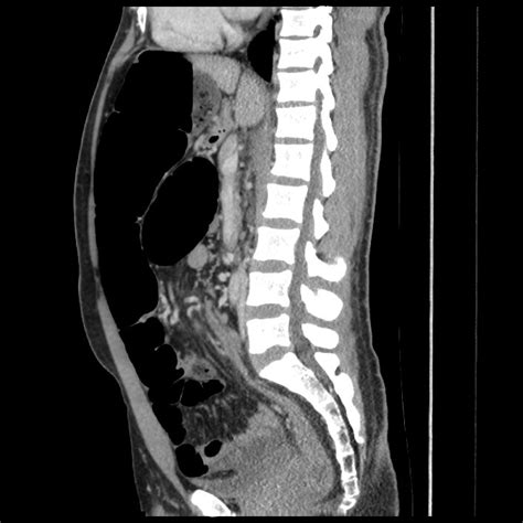 Radiopaedia Case Sigmoid Volvulus Id 62999 Study 71435 Nc Commons