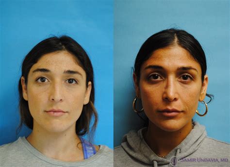 Rhinoplasty Before And After Transformation