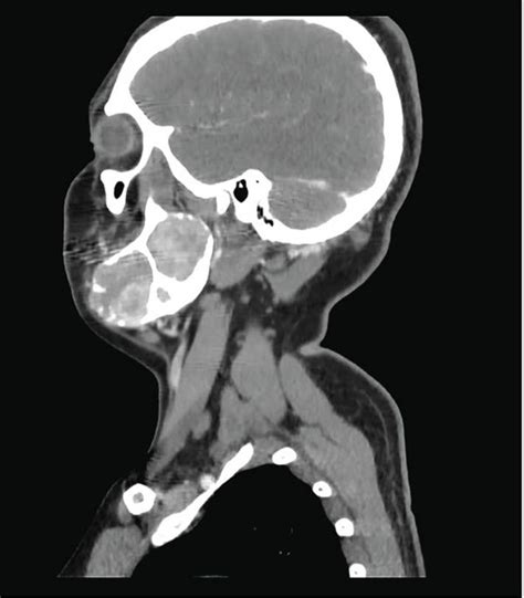 Panoramic Radiograph Revealed A Multilocular Radiolucency In The Body