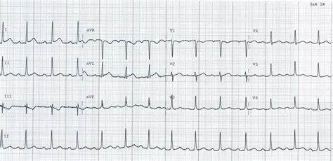 St Elevation In Non Contiguous Leads What Do We Do With That Resus