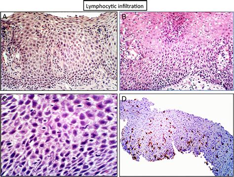 Lymphocytic Oesophagitis Eosinophilic Oesophagitis And Compound