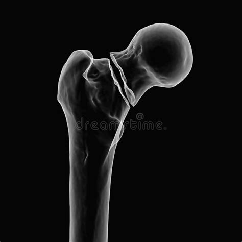 Transcervical Femur Fracture 3d Illustration Stock Illustration Illustration Of Repair