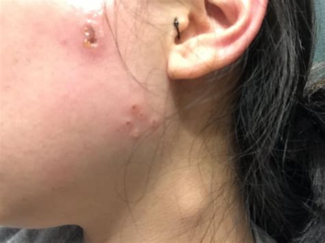 Bug Bite Vs Staph Infection