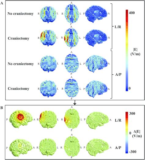 Topographical Effect Of Craniectomy For A Deeply Seated Tumor A Field Download Scientific