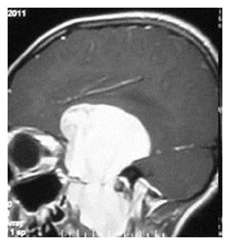 Preoperative Images Showing A Large Middle Cranial Fossa Lesion With Download Scientific
