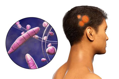 Scalp Fungus Hair Loss What Is It Cosmedica