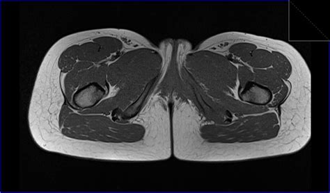 Hamstring Injury Mri Radiology Article On Hamstring Injury