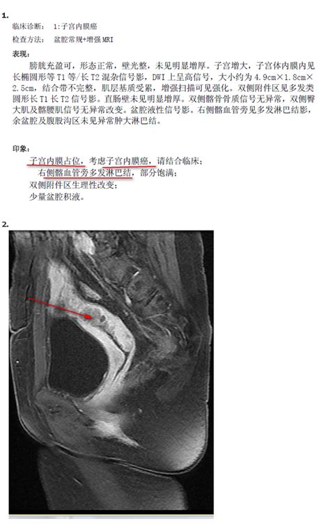 子宫内膜癌一例 医联