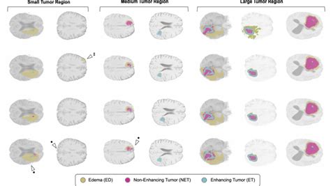 Segmentation Results For Samples From Brats 2017 Test Dataset Over