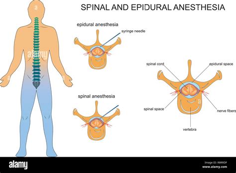 Spinal Block
