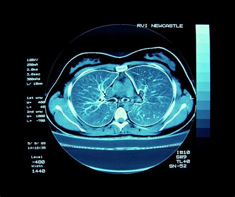 Ct Scan Showing Normal Lungs 1 By Science Photo Library