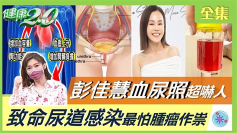 彭佳慧血尿照超嚇人！致命尿道感染 最怕腫瘤作祟！染疫後竟頻尿 尿不乾淨！尿路動力學揪出攝護腺肥大！尿尿無力按1穴強化膀胱肌力！腎虛夜尿必吃這些