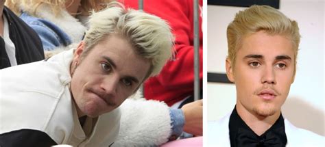 Justin Bieber Hair Loss Everything You Need To Know