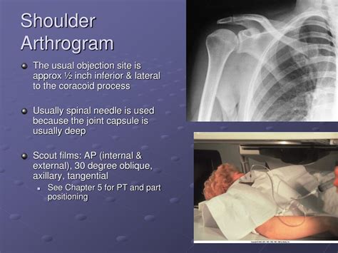 Ppt Arthrography Powerpoint Presentation Free Download Id 443478