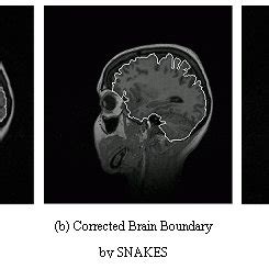 Brain Boundaries Detected By Proposed Method And By Naked Eyes