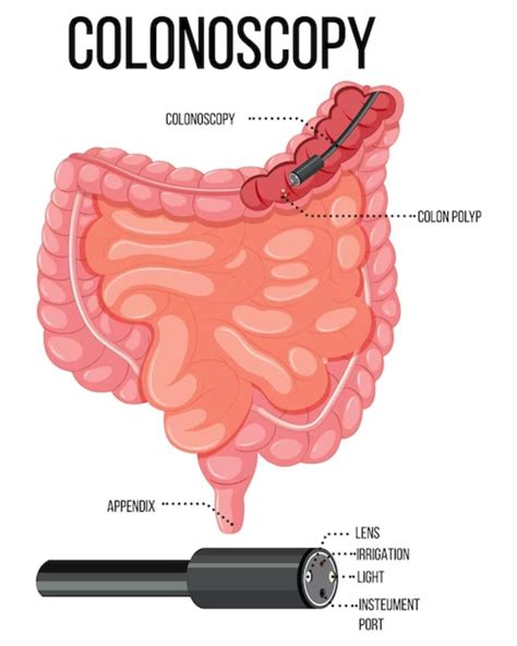 Best Colonoscopy Treatment In Rewari