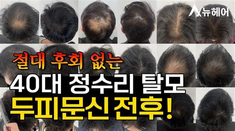두피문신 후회 없는 40대 정수리 가르마 Smp 전후사진ㅣ뉴헤어 Youtube