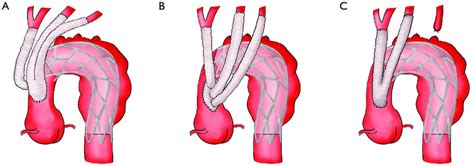 Operative Technique Of Single Stage Type I Hybrid Total Aortic Arch Download Scientific Diagram