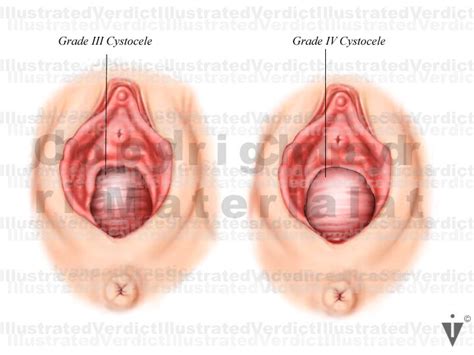 Cystocele Grading