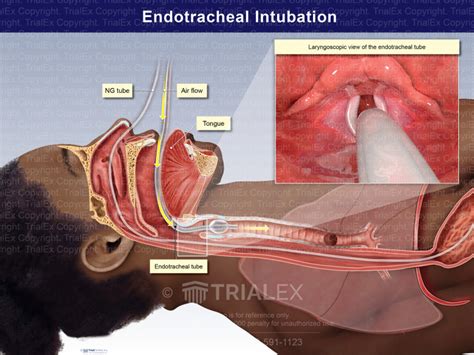 Endotracheal Intubation Trial Exhibits Inc