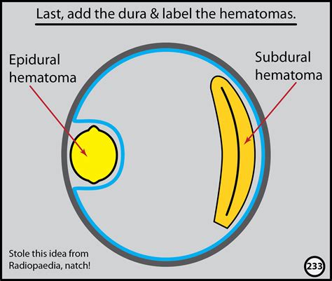 Subdural Hematoma Vs Epidural Hematoma