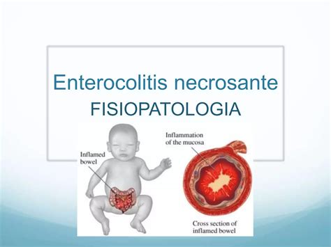 Enterocolitis Necrotizante Pptx