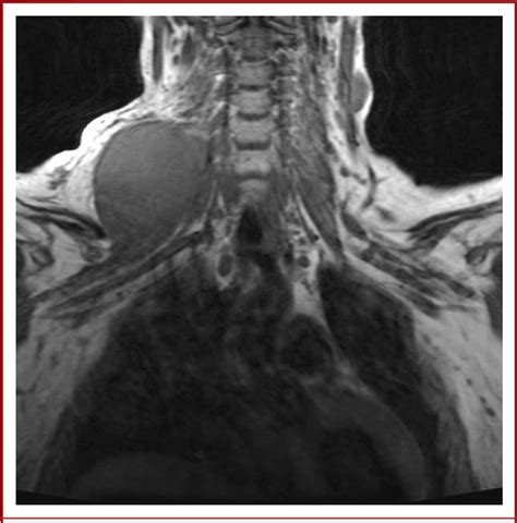 Figure 1 From Brachial Plexus Reconstruction Following Resection Of A Malignant Peripheral Nerve