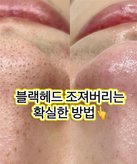 건대피부관리 코에 낀 블랙헤드화이트헤드소극성속모증을 한번에 해결하는 클린코 네이버 블로그
