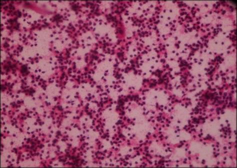 Reactive Lymph Node Hyperplasia Smear Showing A Polymorphous Download Scientific Diagram