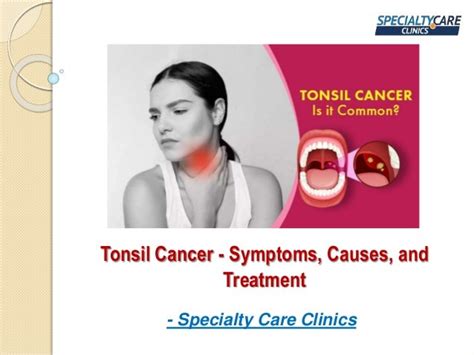 Tonsil Cancer Symptoms Causes And Treatment Ppt Free Download