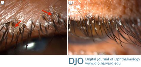 Phthiriasis Palpebrarum A Rare Cause Of Blepharoconjunctivitis