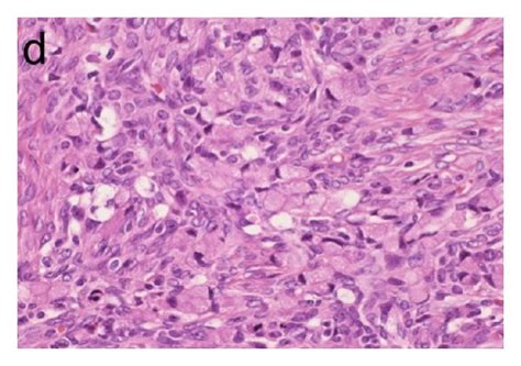 Macroscopic And Microscopic Findings In The Resected Ovarian Tumors