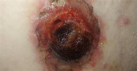 Hole In Nopple After Nipple Graft On Top Surgery Album On Imgur
