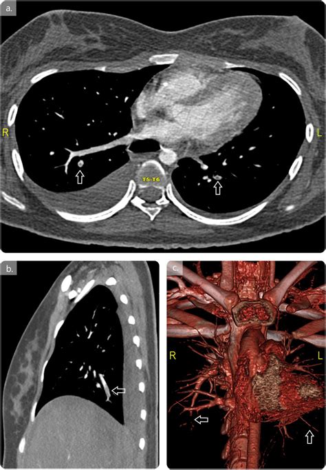 Ct Angiogram Chest Hot Sex Picture