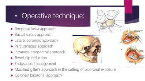 Fractures Of Zygomatic Bone Pptx