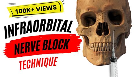 Dental Block Infraorbital At Javier Cox Blog