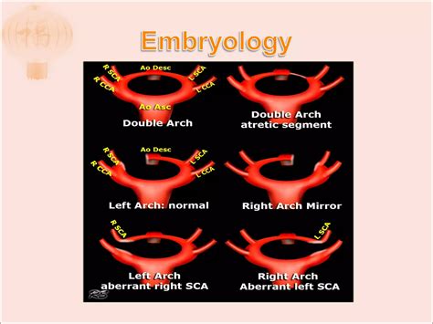 Vascular Anomalies Of Aorta Ppt