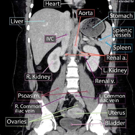 Gross Anatomy Glossary Coronal Abdominal Ct Ditki Medical