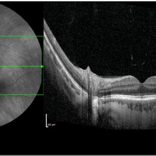 Twelve Months Post Operatively OCT Scan Showing Persistent Subretinal Download Scientific